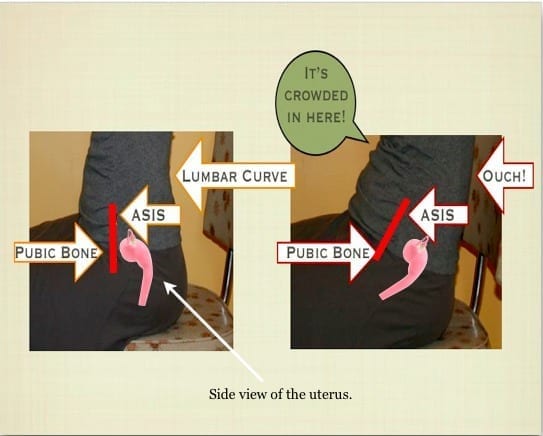 Retroverted Uterus a Natural Solution - Alignment Monkey