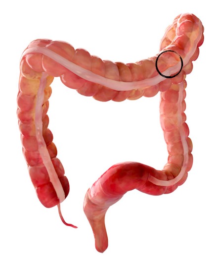 Colon Healing: Laxative Abuse - Alignment Monkey